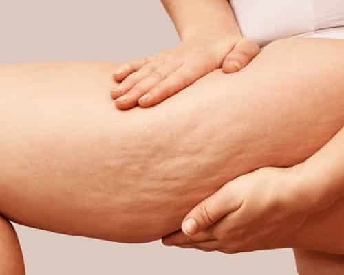 Cellulite Reduction Treatment - VIVO Body Studio