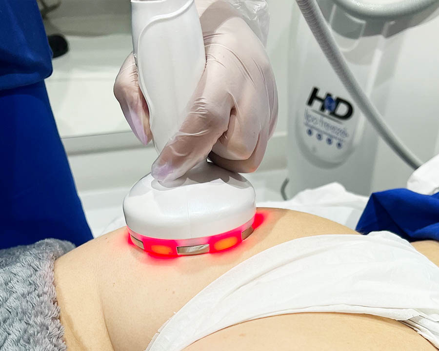 Non-surgical Brazilian Bum Lift - VIVO Body Studio